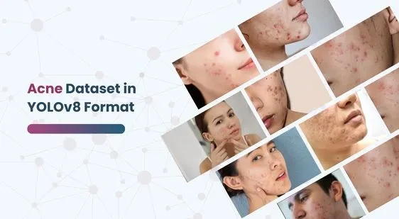 Acne Dataset In Yolov8 Format