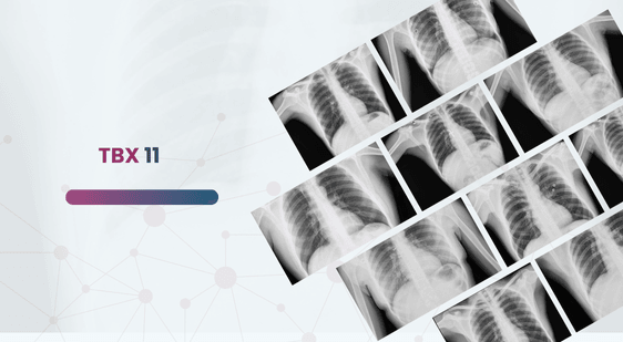 TBX 11 Dataset: X-ray Images for Tuberculosis Detection